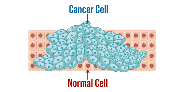 cancer symptoms | Cancer Treatment & Prevention | Cancer Types
