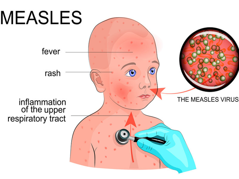 Measles Outbreaks 2025 | Measles Vaccination | Symptoms
